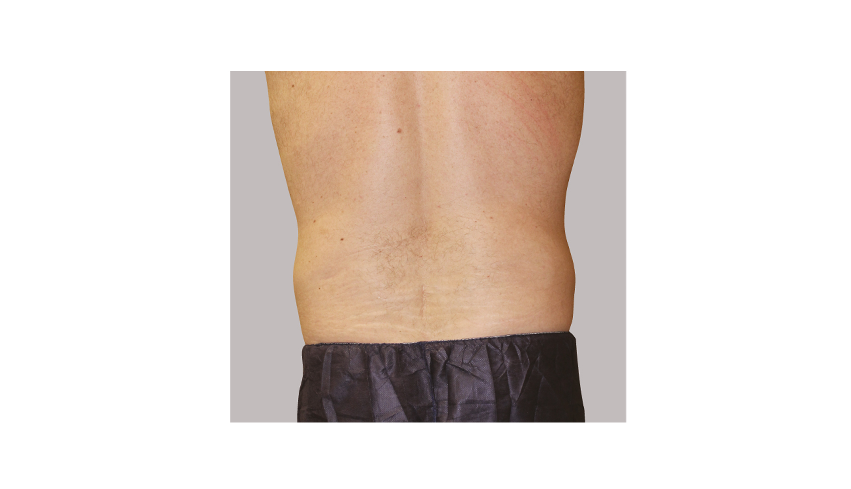 See The Real Results with Cooltech Define Treatments | Cooltech Define ...