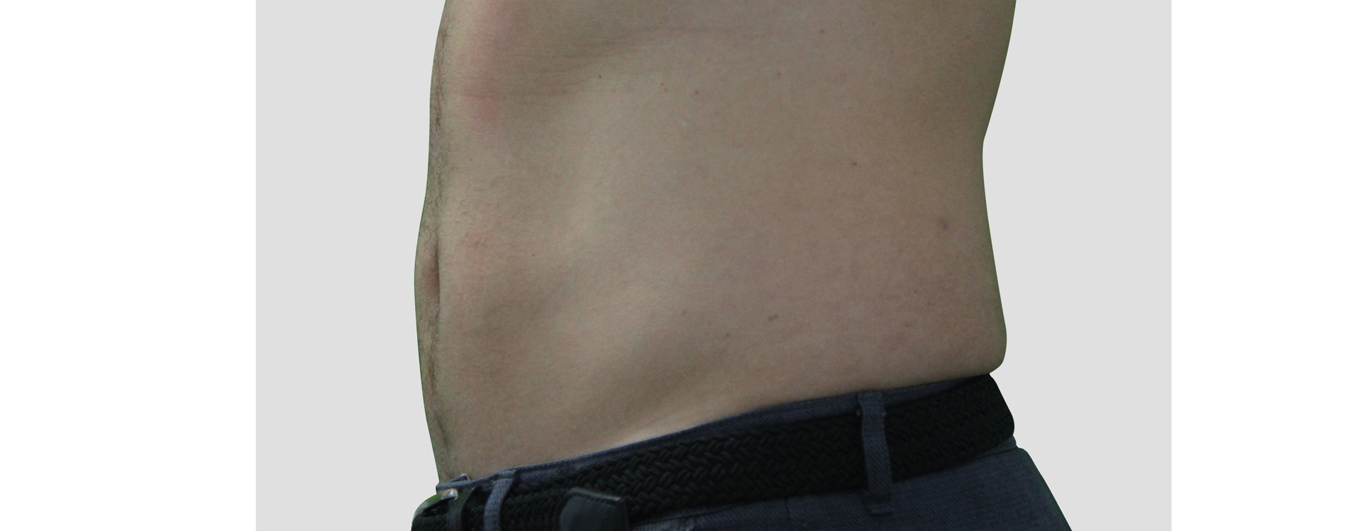 See The Real Results with Cooltech Define Treatments | Cooltech Define ...